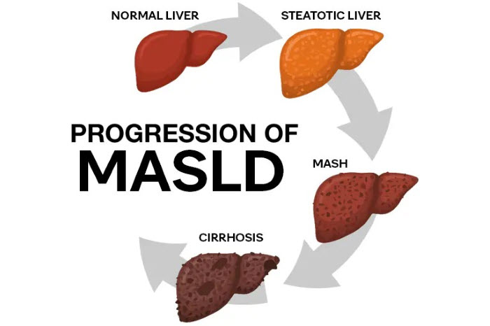 MASLD (Metabolic Dysfunction-Associated Steatotic Liver Disease) in USA ...